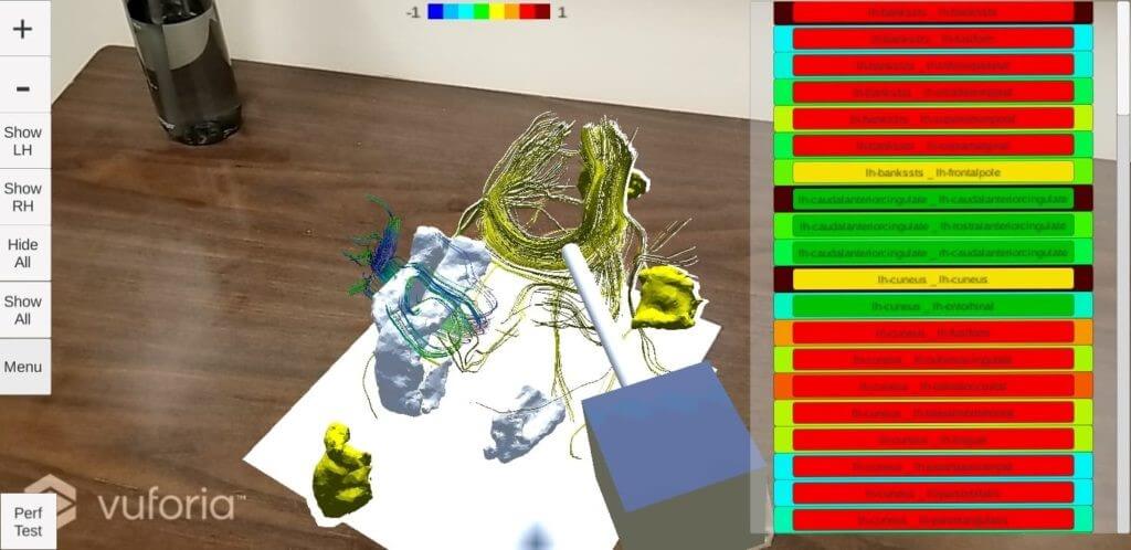 Bringing Augmented Reality to Brain Surgery - Brain Tumour Foundation ...